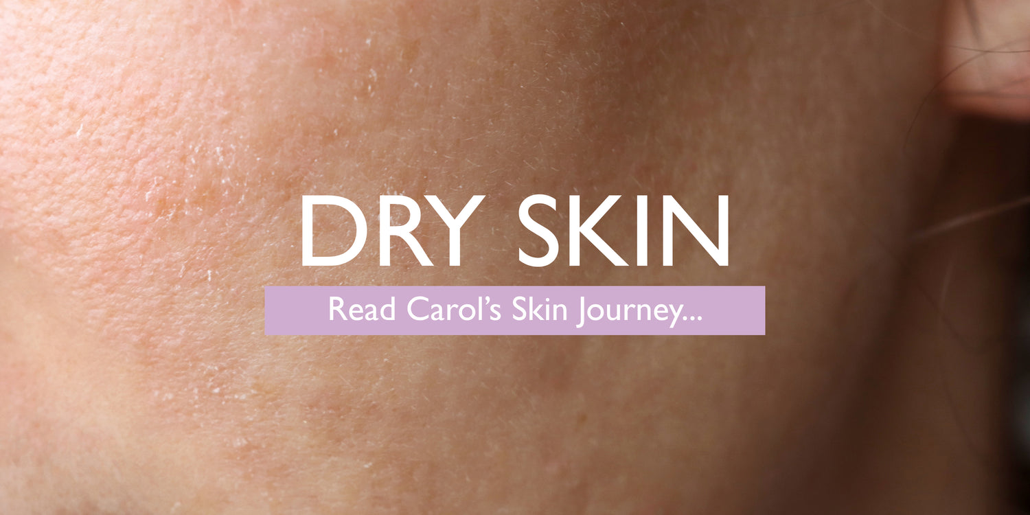 Carol’s Dry Skin Journey to Happy, Healthy Skin | SKINICIAN – Skinician