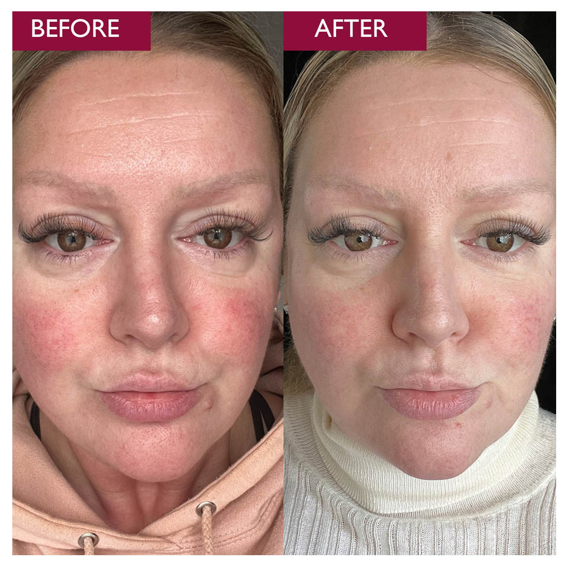 Butcher’s Broom for Skin – SKINICIAN