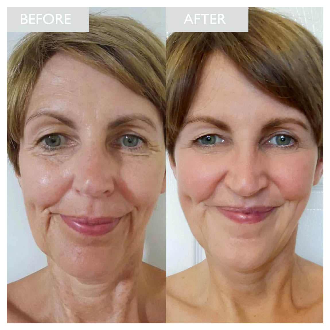 Retinoic Acid Skin Care - Retinoic Acid Benefits for Skin – SKINICIAN