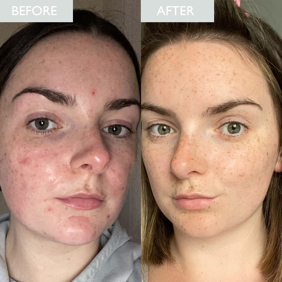 Zinc PCA Skin Care - Zinc PCA Benefits for Skin – SKINICIAN